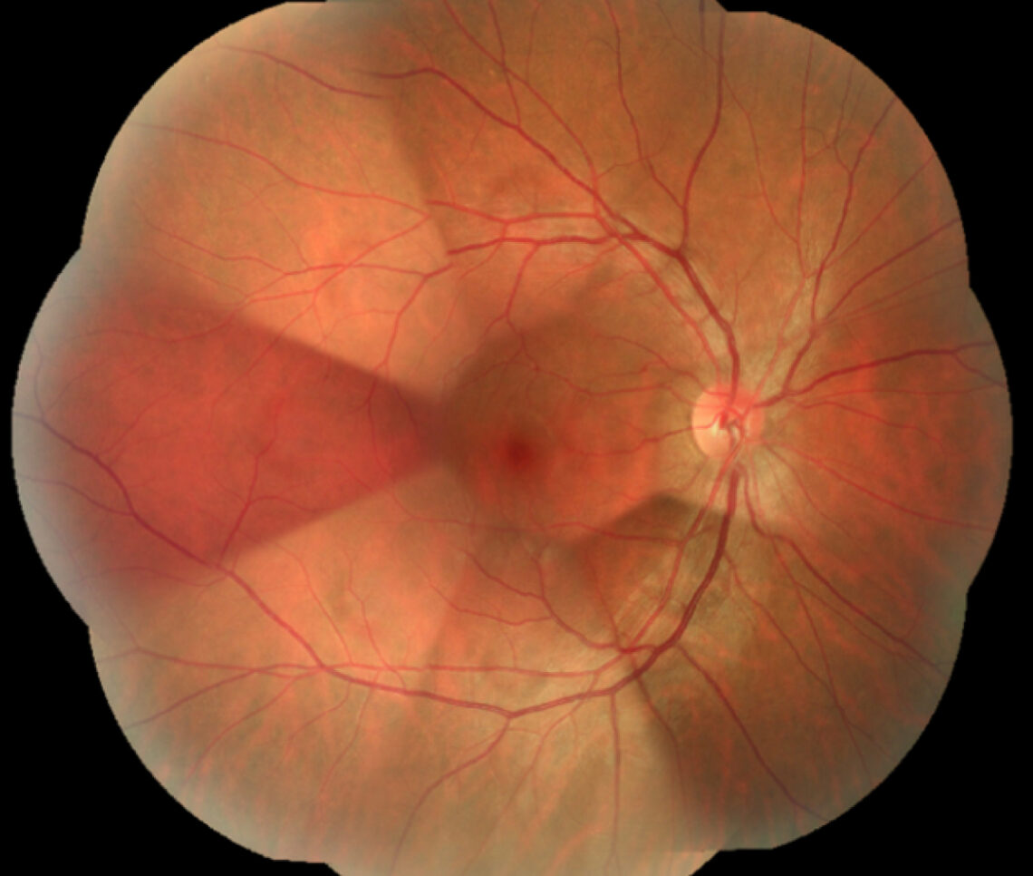 Non-Mydriatic Fundus Camera SYSEYE Kestrel 3100m - Lenscan Medical Inc.